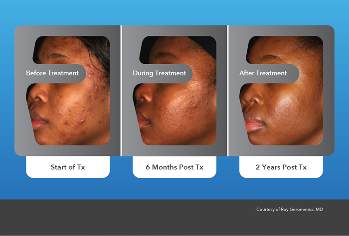 Accure Acne Online Store