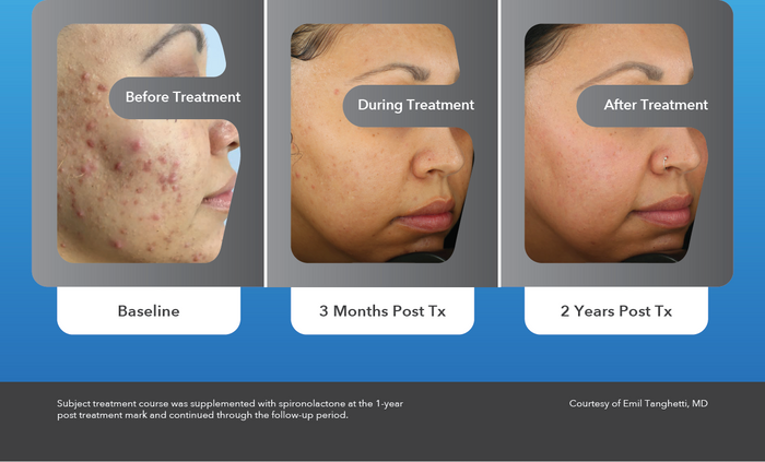 Accure Acne Online Store